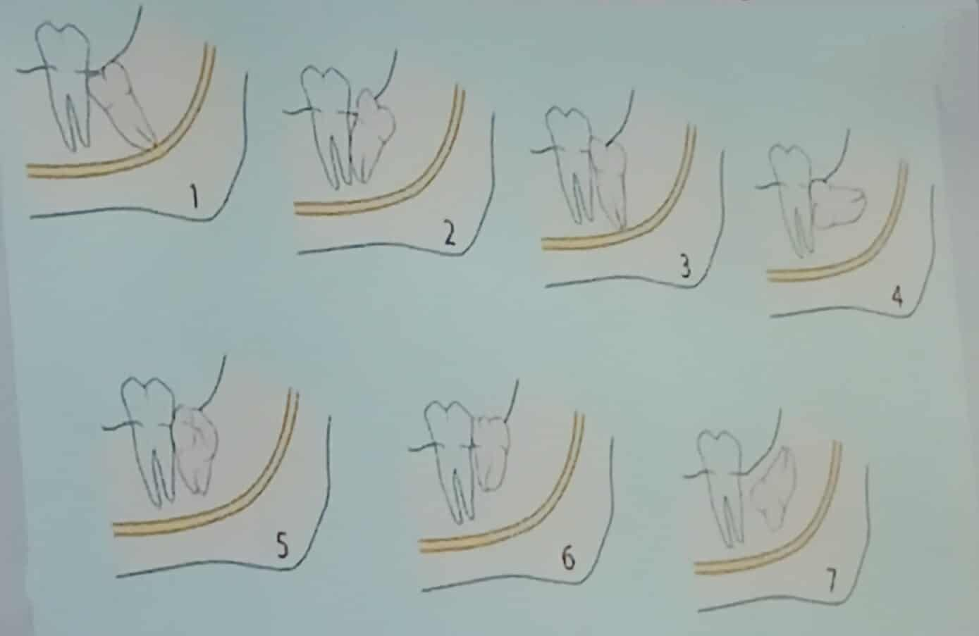 Oral and Maxillofacial Surgery | Flashcards