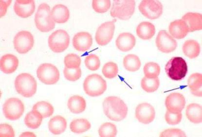 Hématologie | Flashcards