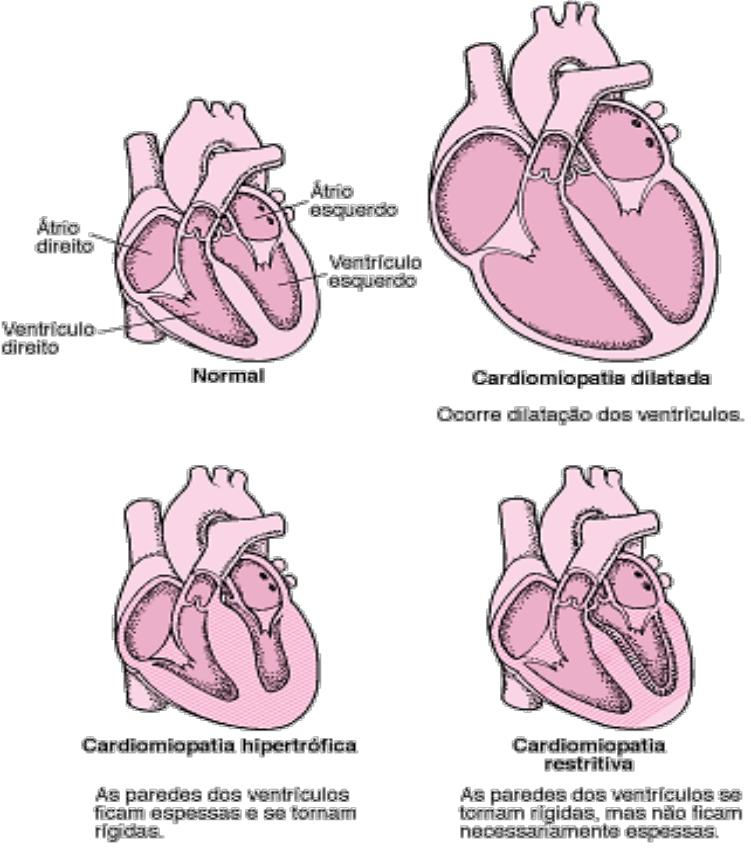 Insuficiência Cardiaca | Flashcards