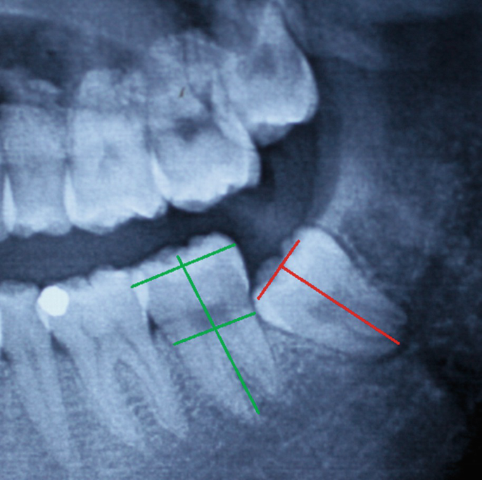 Oral and Maxillofacial Surgery | Flashcards