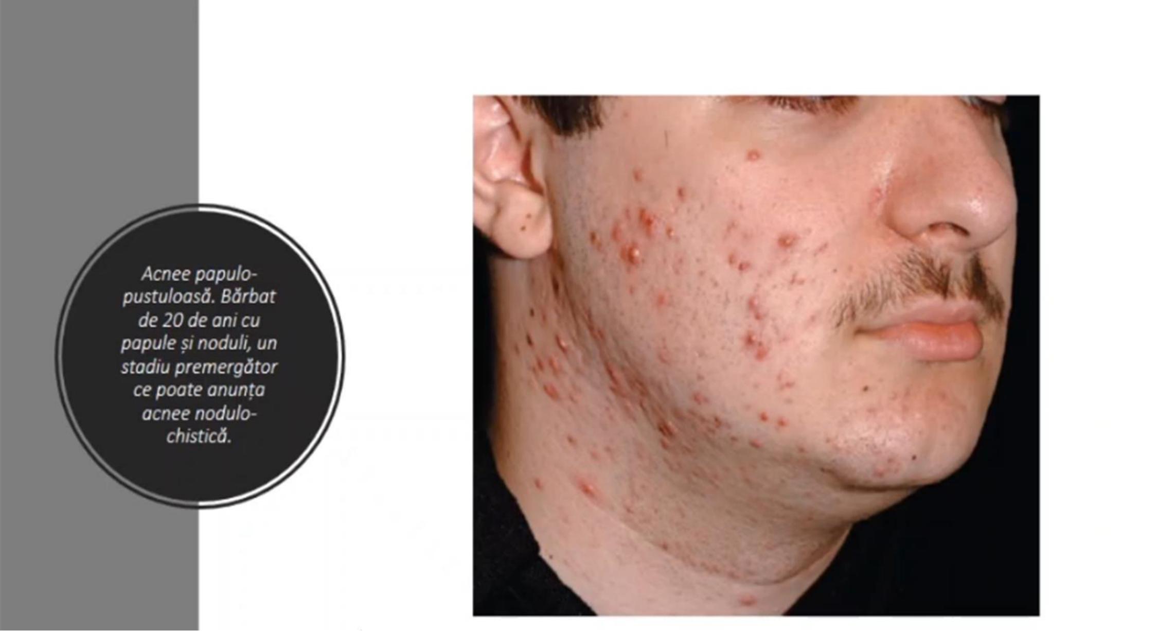 Dermato | Flashcards