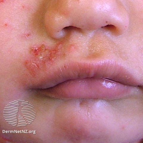 Impetigo | Flashcards