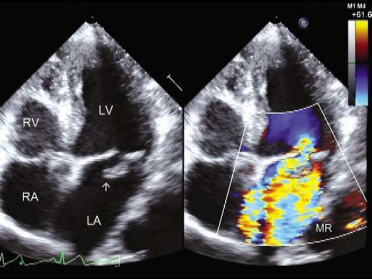Mitral Regurgitation | Flashcards